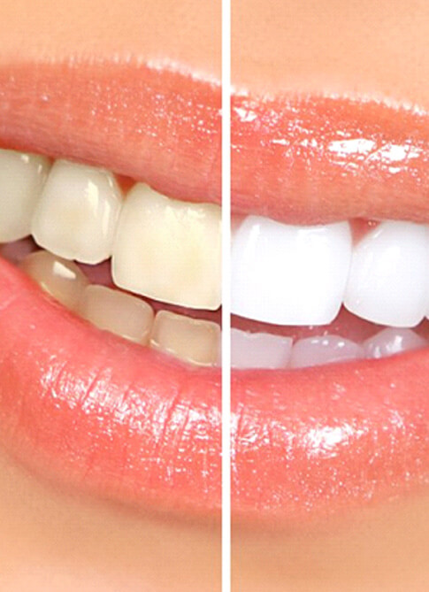 Teeth Whitening Mankato, MN | Cosmetic Dentist | Hyland Dental